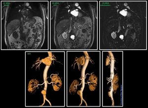 CE-MRA - abdominal aortic aneurysm @ Siemens 1.5T - MEDizzy