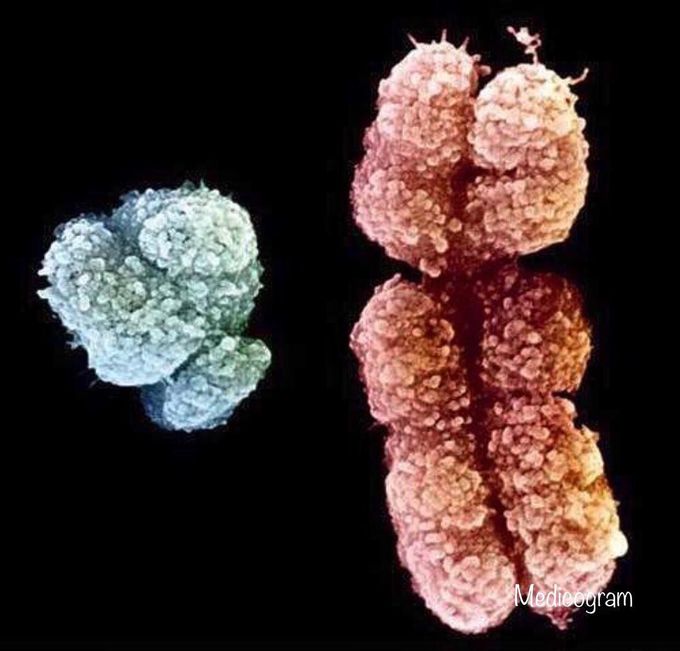 Human Y and X chromosomes :) - MEDizzy