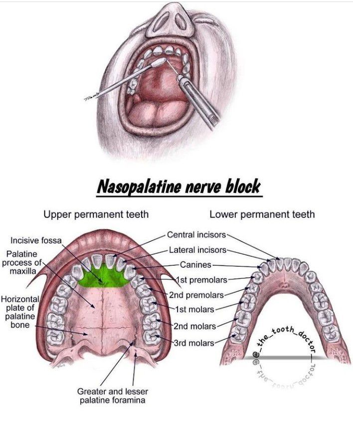 Nasopalatine Nerve Block Landmarks
