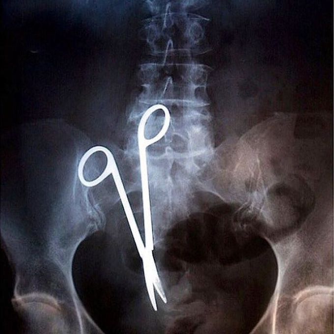 An x-ray showing surgical scissors left in the abdomen! - MEDizzy