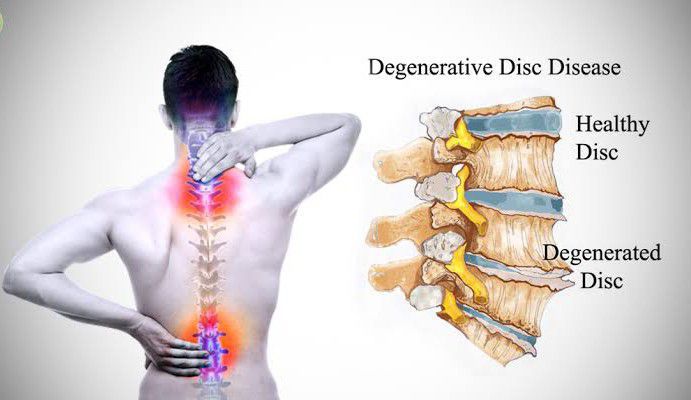 This is the comparison between healthy and degenerated disc - MEDizzy