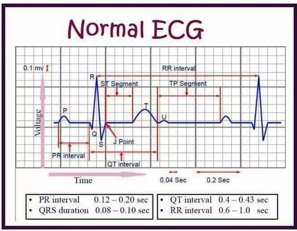 Normal ECG MEDizzy