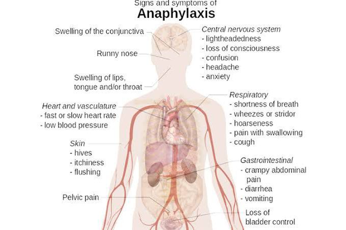 Symptoms of anaphylaxis. - MEDizzy