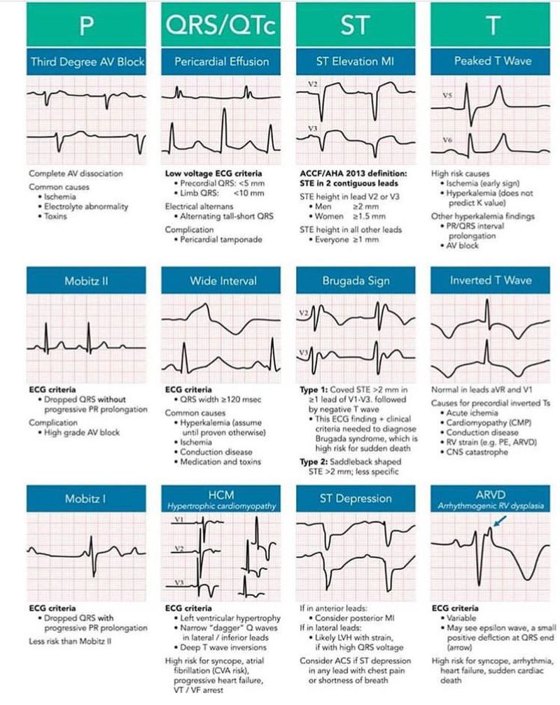EKG reading - MEDizzy