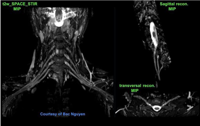 brachial plexus MRI Neurography @ Siemens 3T Skyra - MEDizzy