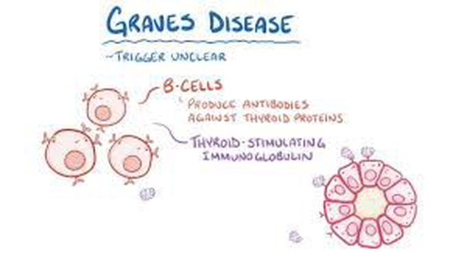 What is graves disease - MEDizzy