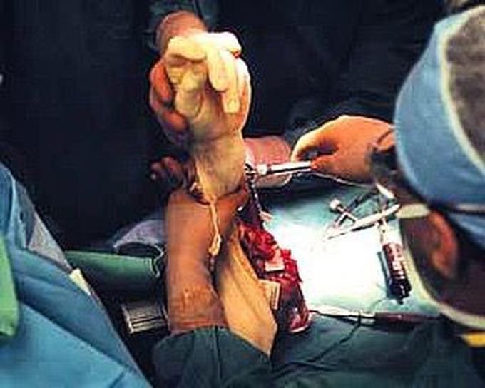 Hand transplantation! - MEDizzy