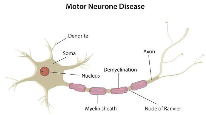 Motor neuron disease - MEDizzy