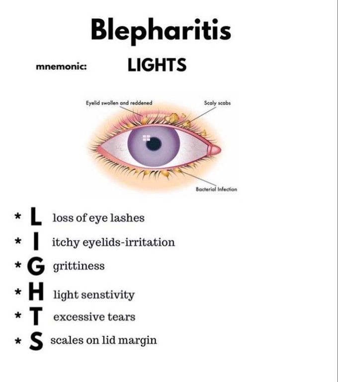 Blepharitis- Mnemonic - MEDizzy