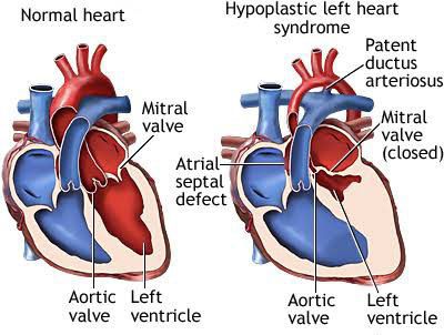 This is the comparison between a normal heart and - MEDizzy