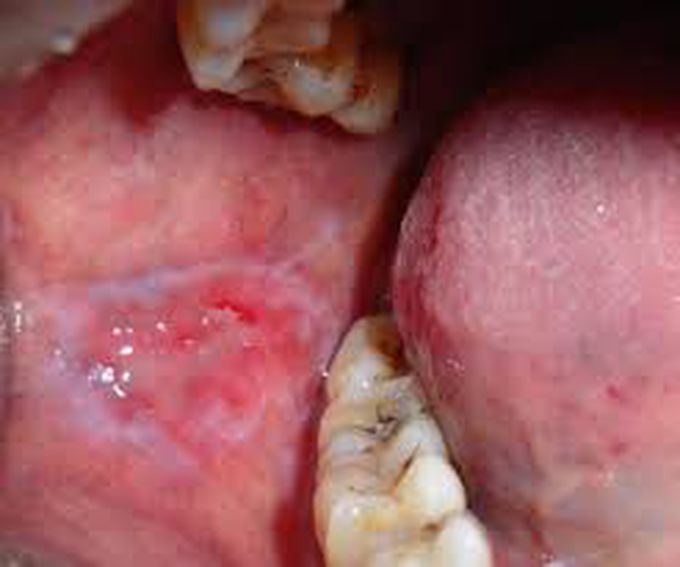 Erosive Lichen Planus Tongue
