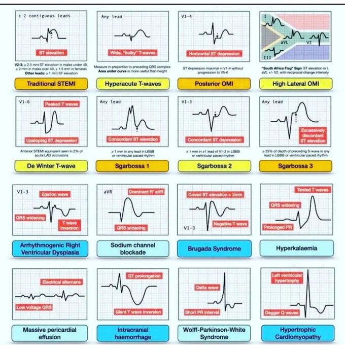 ECG Changes - MEDizzy