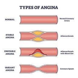 Types of angina - MEDizzy