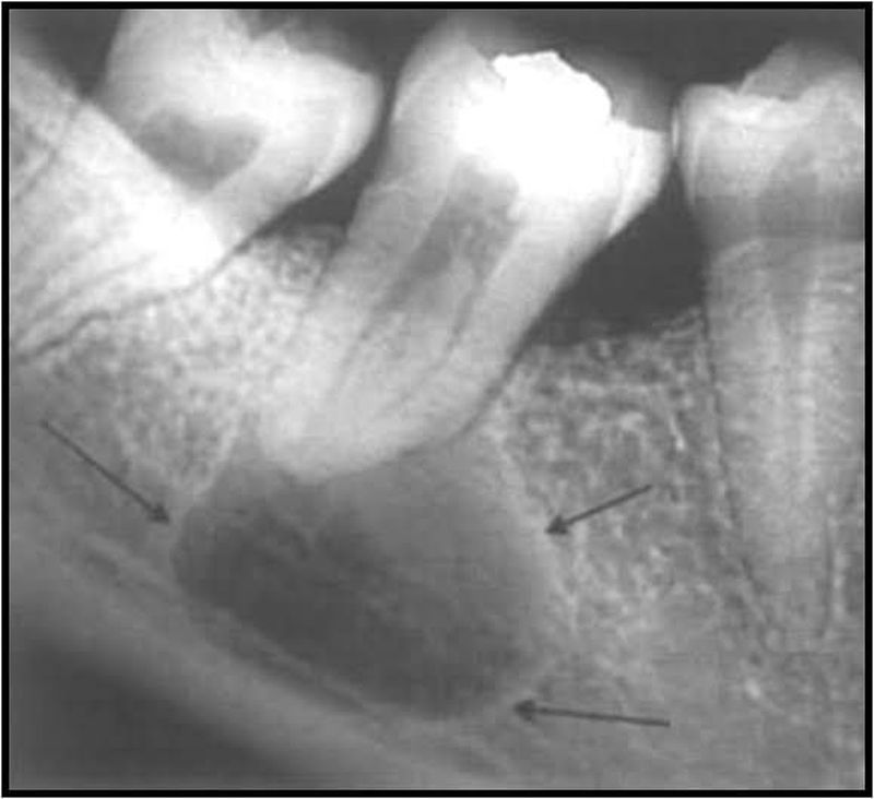 Radicular Cyst A Dental Student's Guide To…odontogenic Cysts