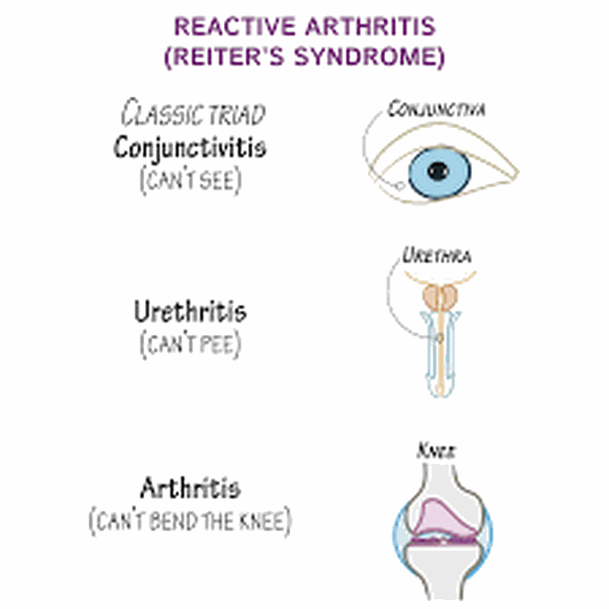 Reactive arthritis - MEDizzy