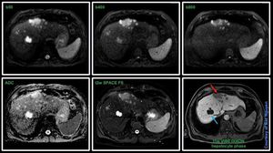 MRI Liver Imaging w/Primovist @ Siemens 1.5T AERA MRI with - MEDizzy