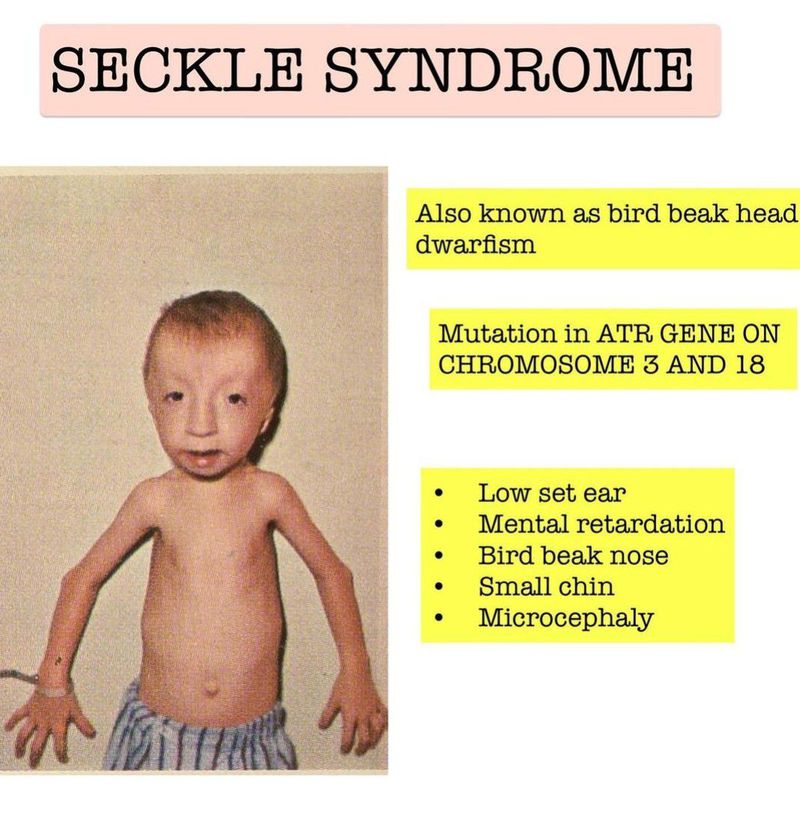 Seckel Syndrome