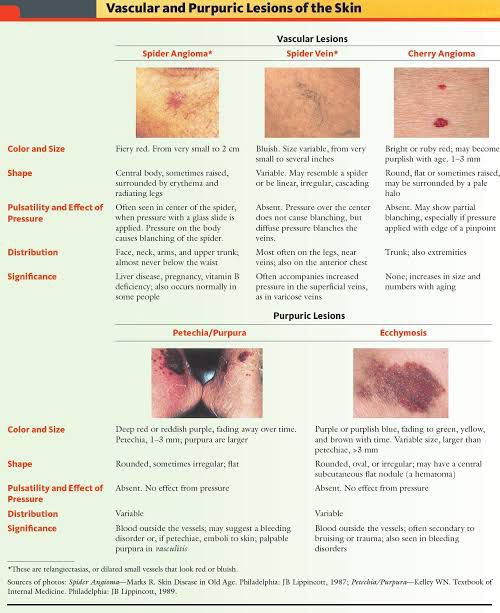 Vascular and Purpuric Lesions of Skin - MEDizzy