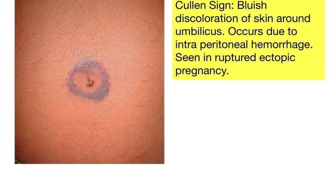 Cullen Sign - MEDizzy
