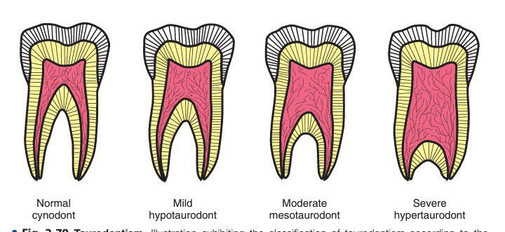 Taurodontism types - MEDizzy