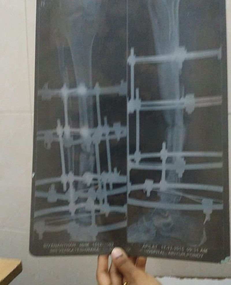 External fixators in an Xray!!! - MEDizzy
