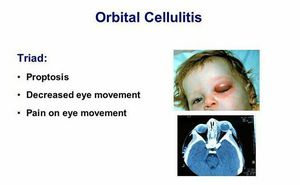 Orbital Cellulitis - MEDizzy