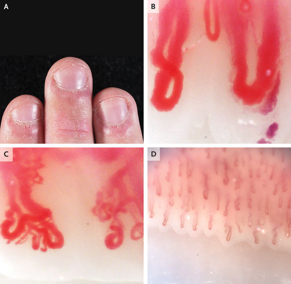 Nail Fold Capillaries PDF] Nailfold Capillaroscopy In Rheumatic