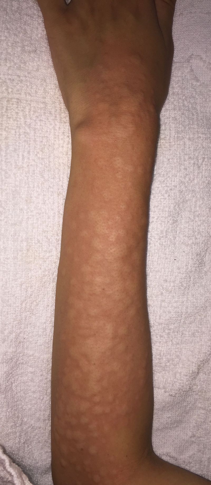 Skin swelling all over the body - MEDizzy