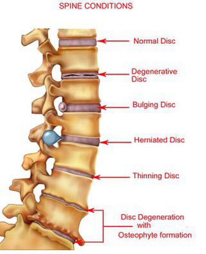 Disc abnormalities - MEDizzy