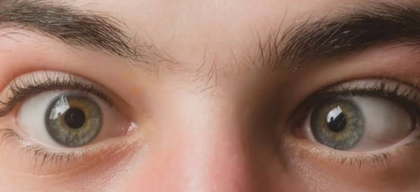 Strabismus - MEDizzy