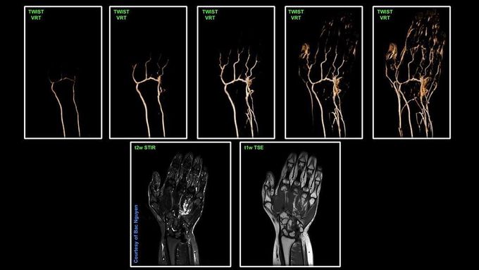 ArterioVenous Malformations (AVM) @ Siemens 3T Skyra. - MEDizzy