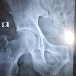 Sacroiliacal joint disruption and inferior ramus pubic - MEDizzy