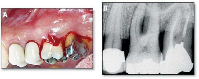 What are the symptoms of a gum abscess? - MEDizzy