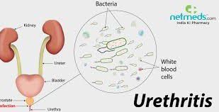 Urethritis - MEDizzy