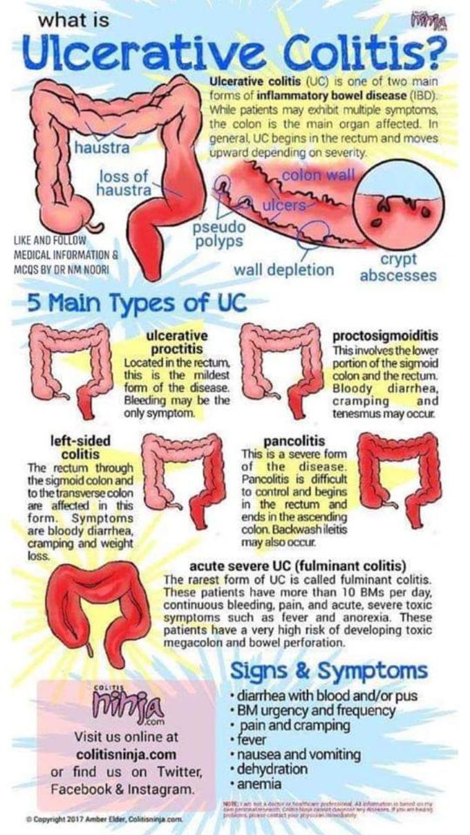 Ulcerative colitis. - MEDizzy
