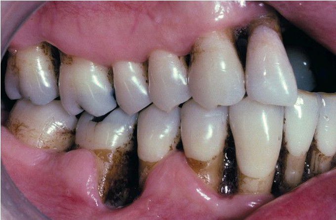 HIV-associated Periodontitis - MEDizzy