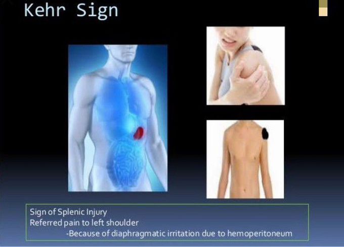 Kehrs sign - MEDizzy