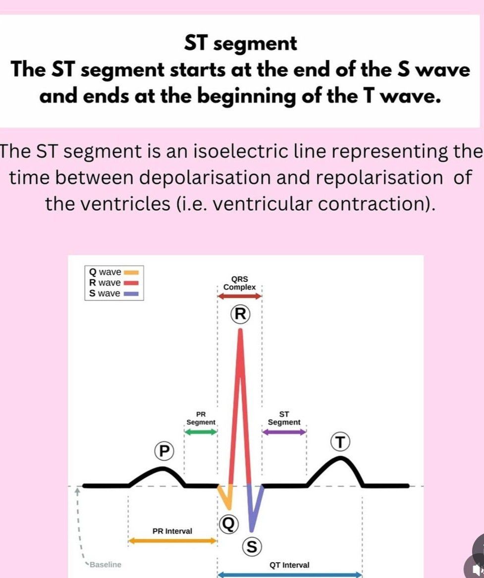 ECG Basics IV - MEDizzy