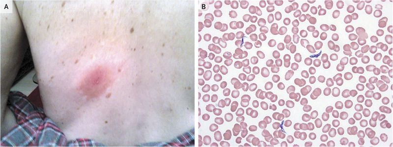 African Trypanosomiasis - MEDizzy