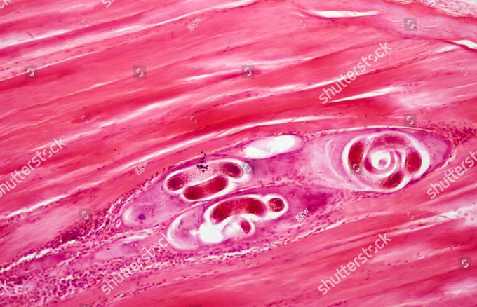 Trichinosis - MEDizzy