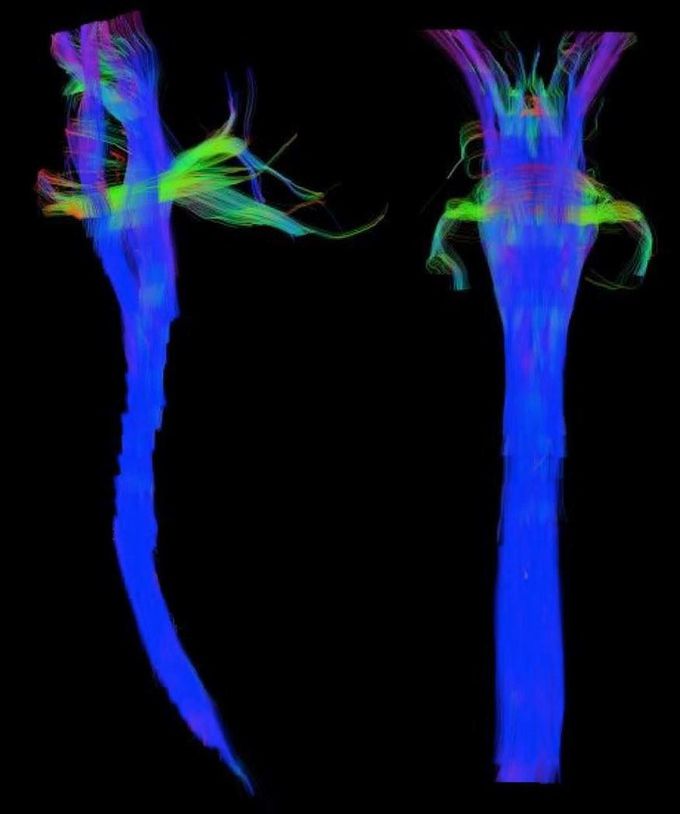 Diffusion Tensor Imaging (DTI) - Simultaneous MultiSlice - MEDizzy
