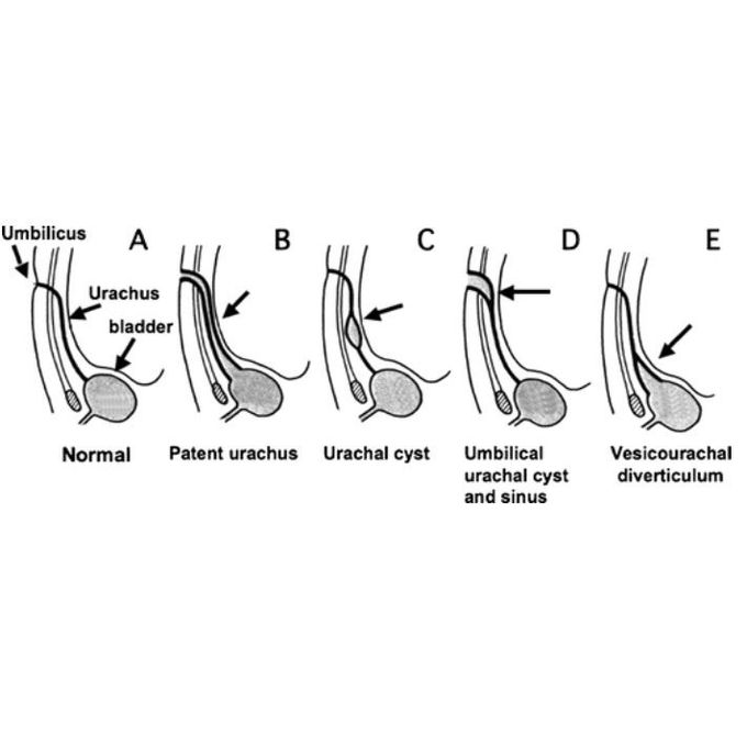 Urinary tract disorder - MEDizzy