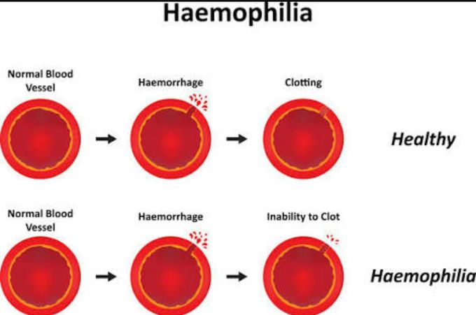 HAEMOPHILIA - MEDizzy