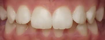 What causes deep bite? - MEDizzy