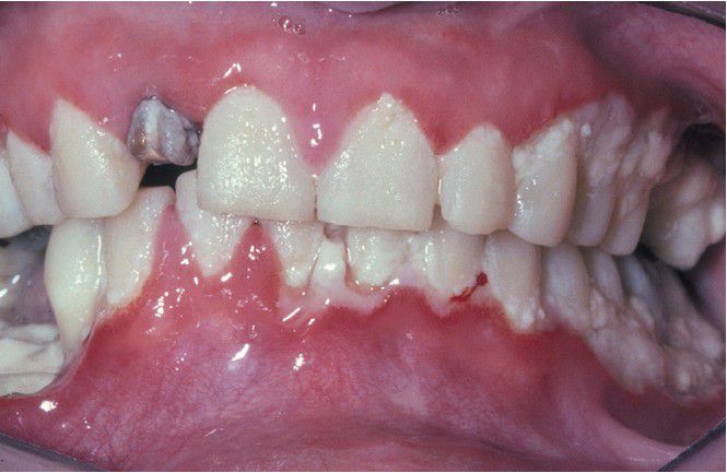HIV-associated Periodontitis with Necrotizing Stomatitis. - MEDizzy