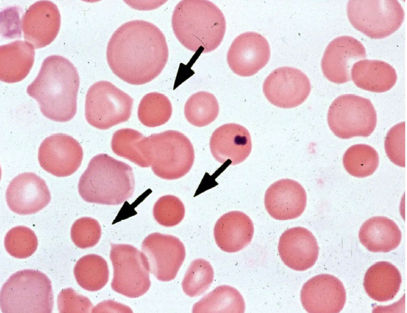 Spherocytes