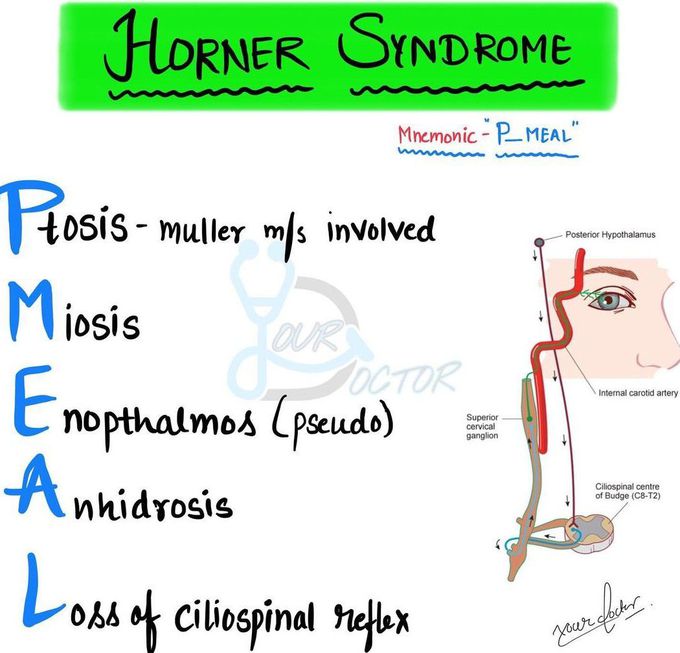 Horner Syndrome - MEDizzy