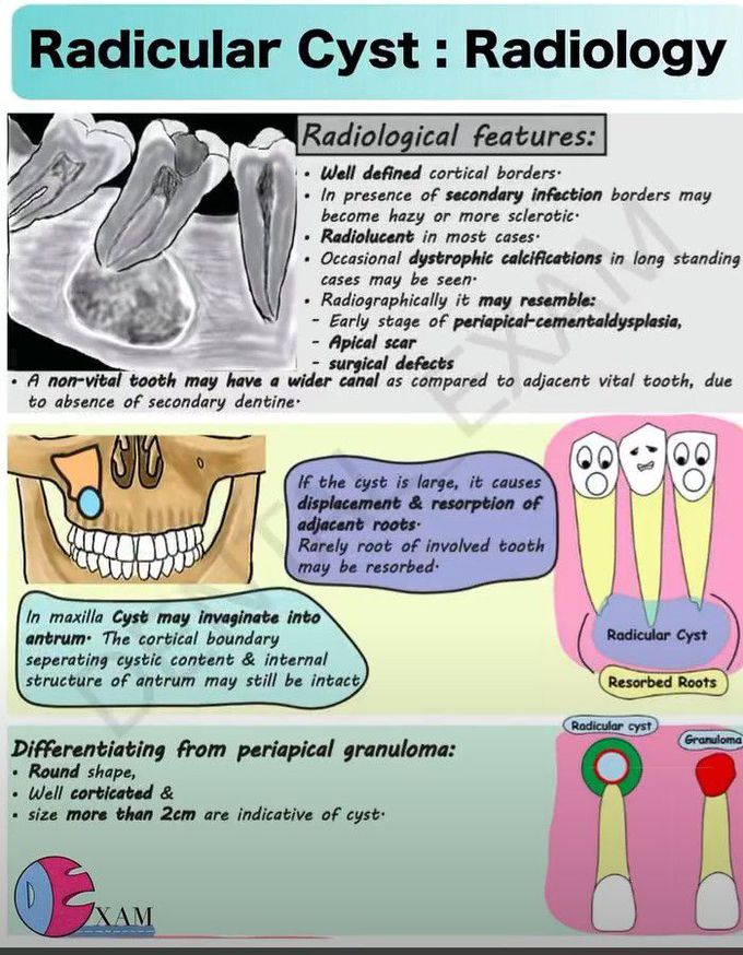Radicular Cyst