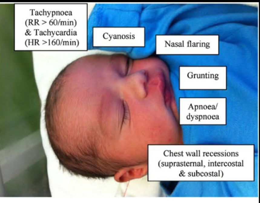 Newborn Respiratory Distress Syndrome Newborn Respiratory MEDizzy