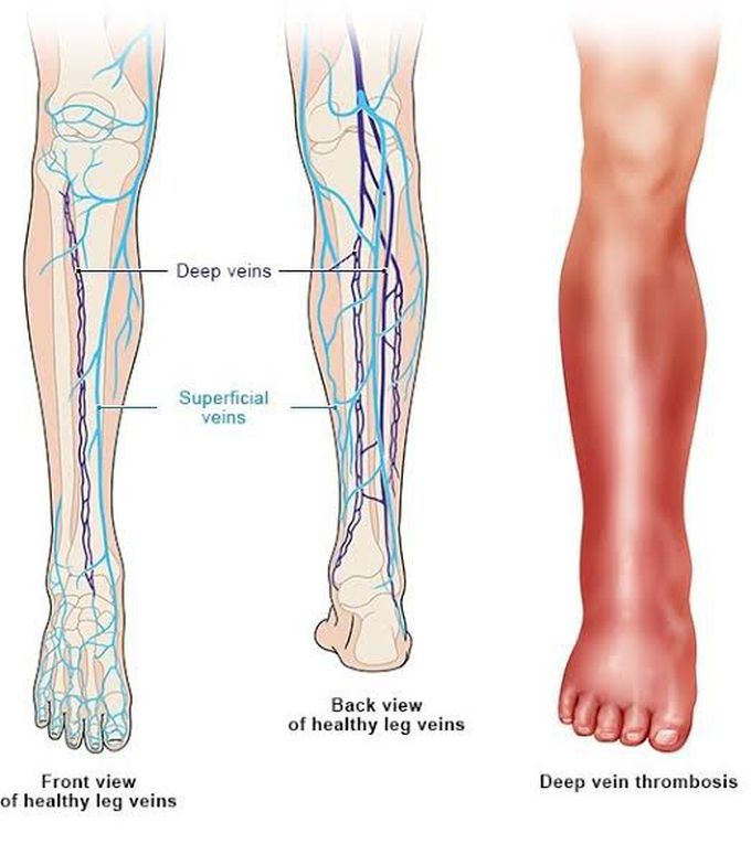 Symptoms of Deep vein thrombosis - MEDizzy